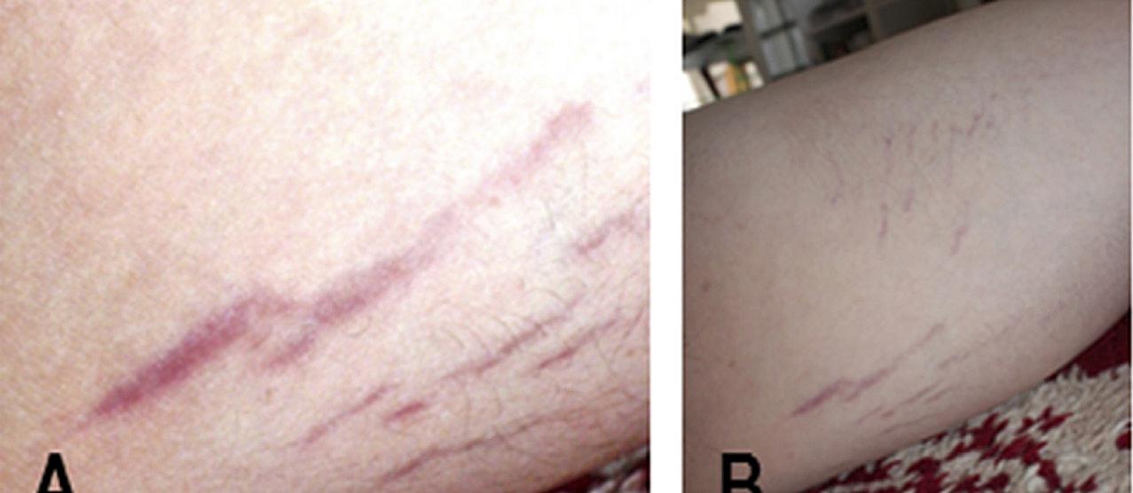 Bartonella – A cause of PANS? - Origins of Health, LLC