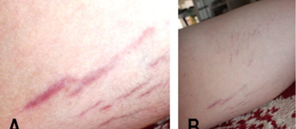 Bartonella track - Origins of Health, LLC